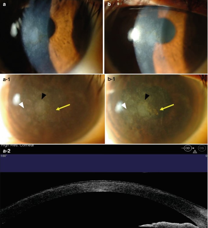 TGFBI Corneal Dystrophies: Thiel-Behnke Corneal Dystrophy (TBCD ...