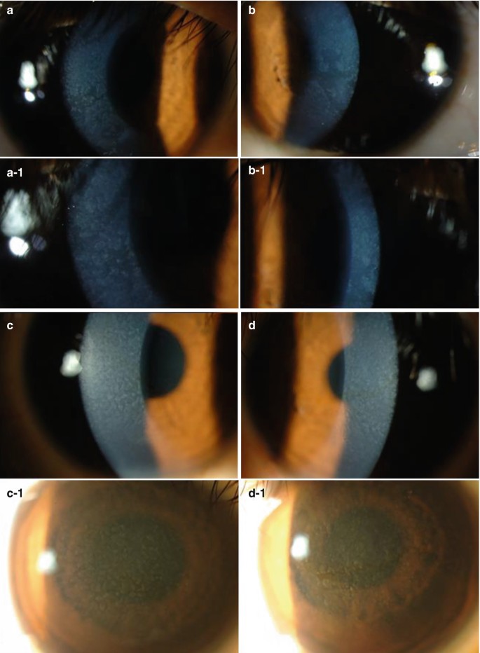 TGFBI Corneal Dystrophies: Thiel-Behnke Corneal Dystrophy (TBCD ...