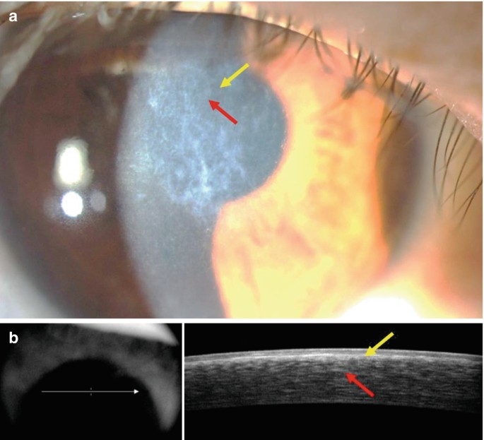 TGFBI Corneal Dystrophies: Lattice Corneal Dystrophy with TGFBI ...