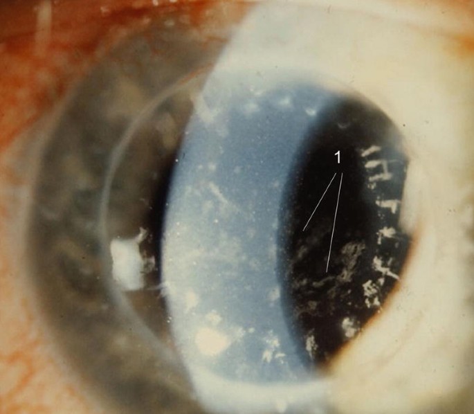 Granular Corneal Dystrophy, Type 1 (Classic) (GCD1) | SpringerLink