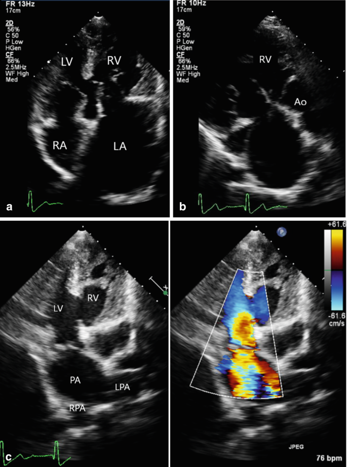 Transposition of Great Arteries | SpringerLink