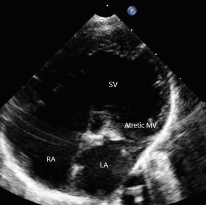 Single Functional Ventricle | SpringerLink