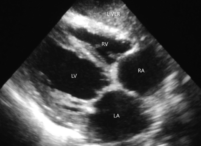 Segmental Anatomy and Cardiac Malpositions | Springer Nature Link ...