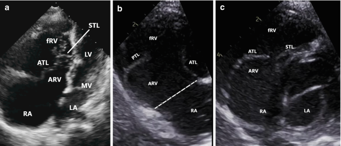 Right Ventricular Inflow Anomalies | SpringerLink