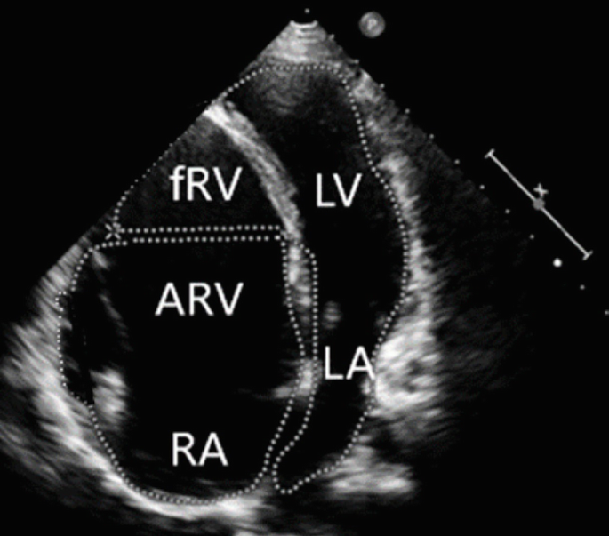 Right Ventricular Inflow Anomalies | SpringerLink