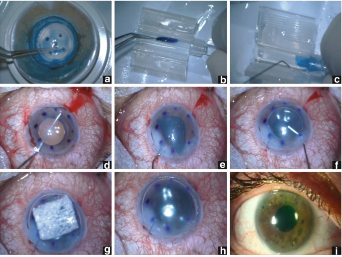 DMEK Triple Procedure in a Case of Delayed Complications Following ...