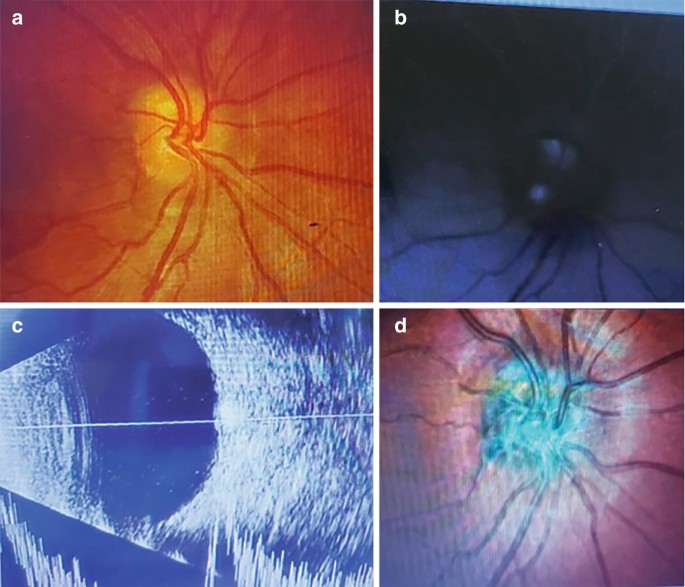 Unilateral Optic Disc Edema in a Young Male | Springer Nature Link