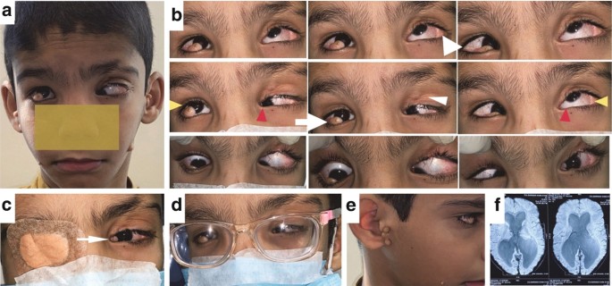 There’s Evil in My Eye: Pediatric Ophthalmology Challenge—Goldenhar ...