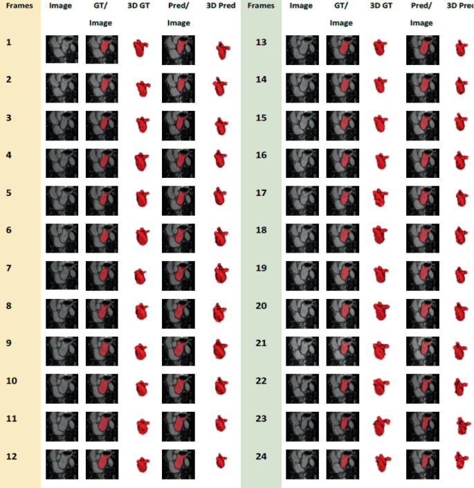 Assessment of Left Atrium Motion Deformation Through Full Cardiac Cycle ...