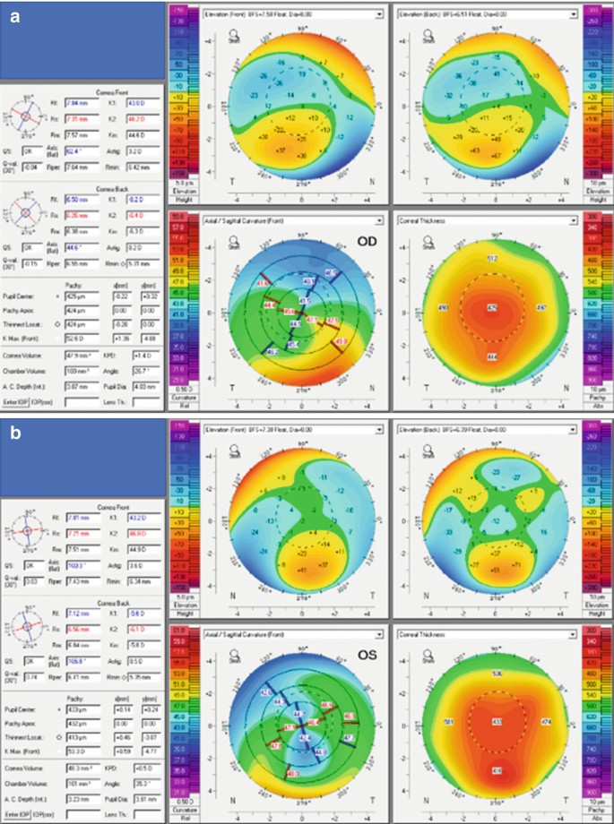 Pellucid Marginal Degeneration | SpringerLink