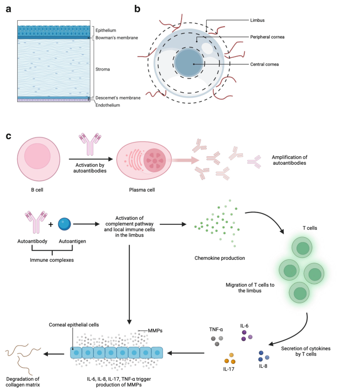 Peripheral Ulcerative Keratitis | SpringerLink