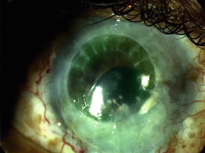 Mooren’s Ulcer | SpringerLink