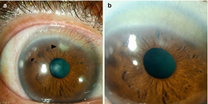 Marginal Keratitis | SpringerLink