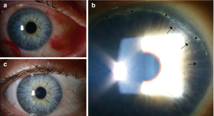 Marginal Keratitis | SpringerLink