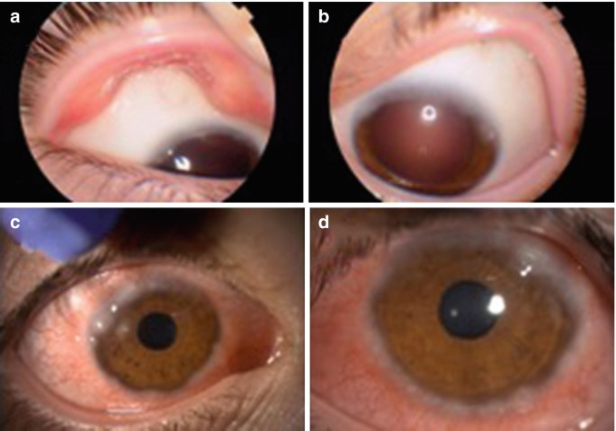 Atopic and Vernal Keratoconjunctivitis | SpringerLink