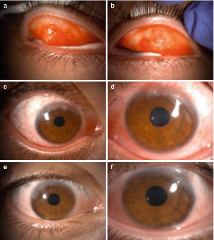 Atopic and Vernal Keratoconjunctivitis | SpringerLink
