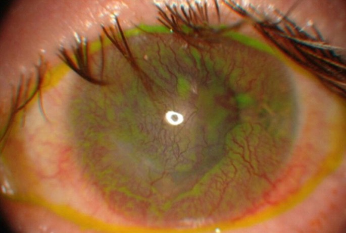Limbal Stem Cell Deficiency | SpringerLink