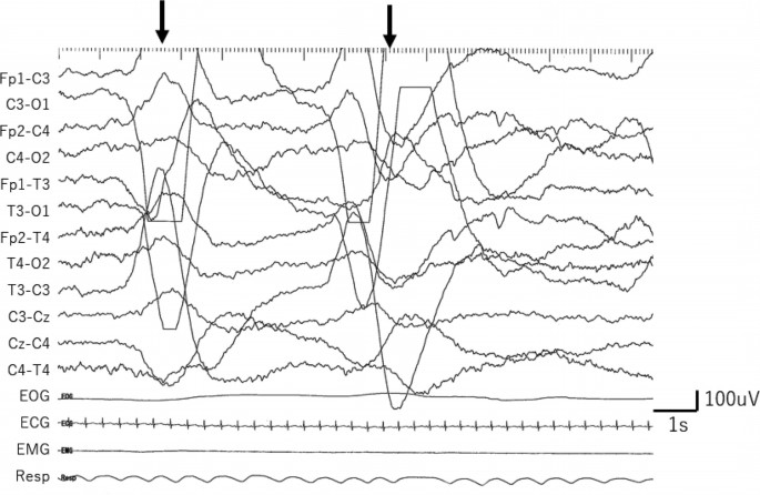 Knowledge of Artifacts Necessary for EEG Interpretation | SpringerLink