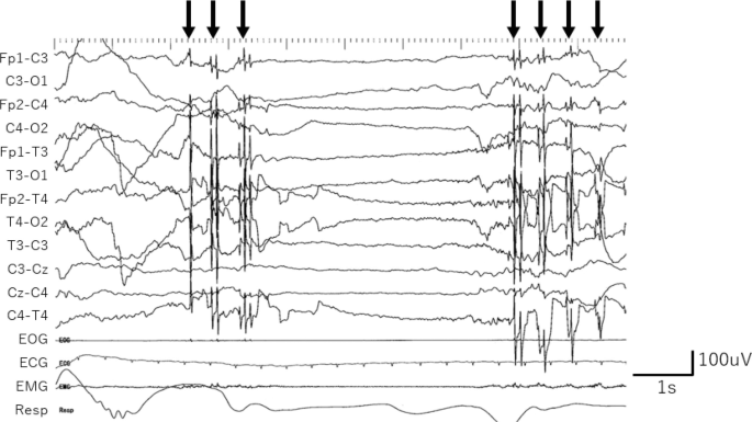 Knowledge of Artifacts Necessary for EEG Interpretation | SpringerLink