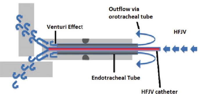 Jet Ventilation | SpringerLink