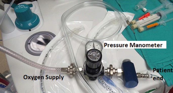 Jet Ventilation | SpringerLink