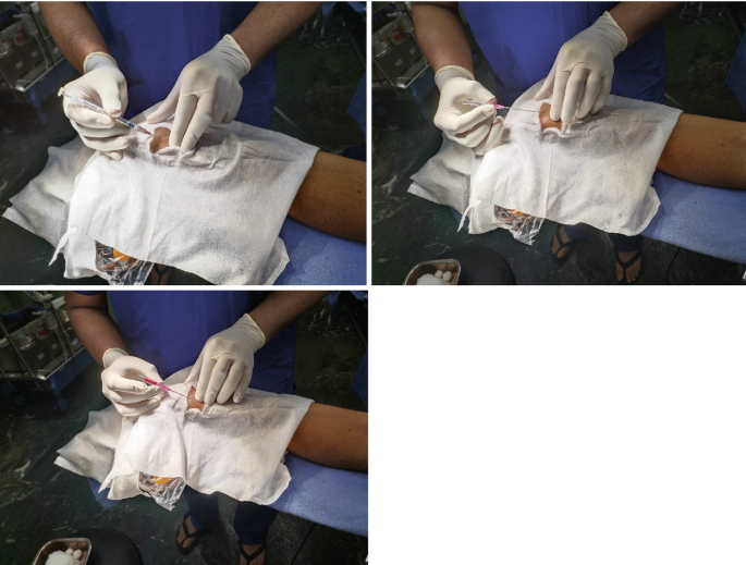 Arterial Blood Gas Sampling and Pitfalls | Springer Nature Link ...