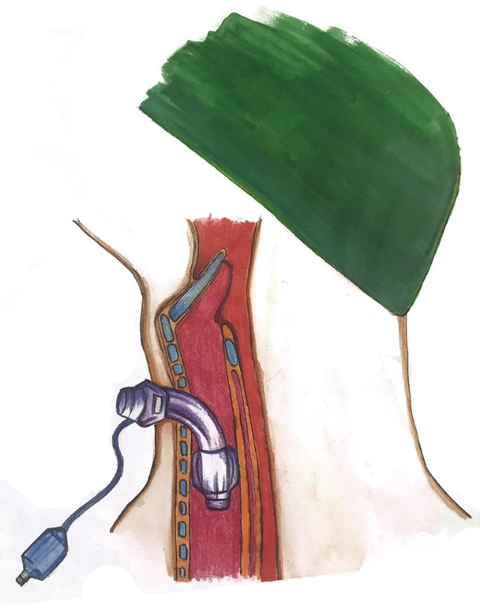 Tracheostomy | SpringerLink