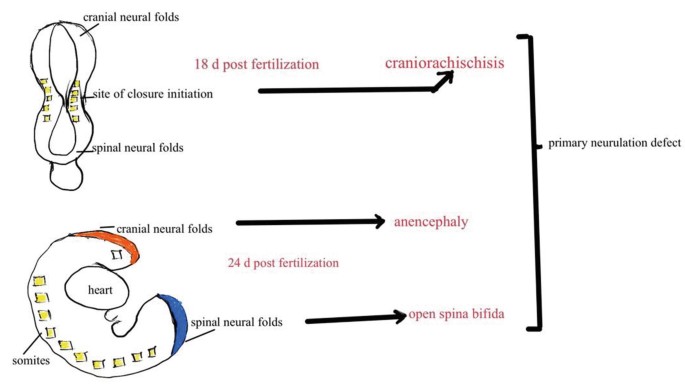 Neural Tube Defects | SpringerLink