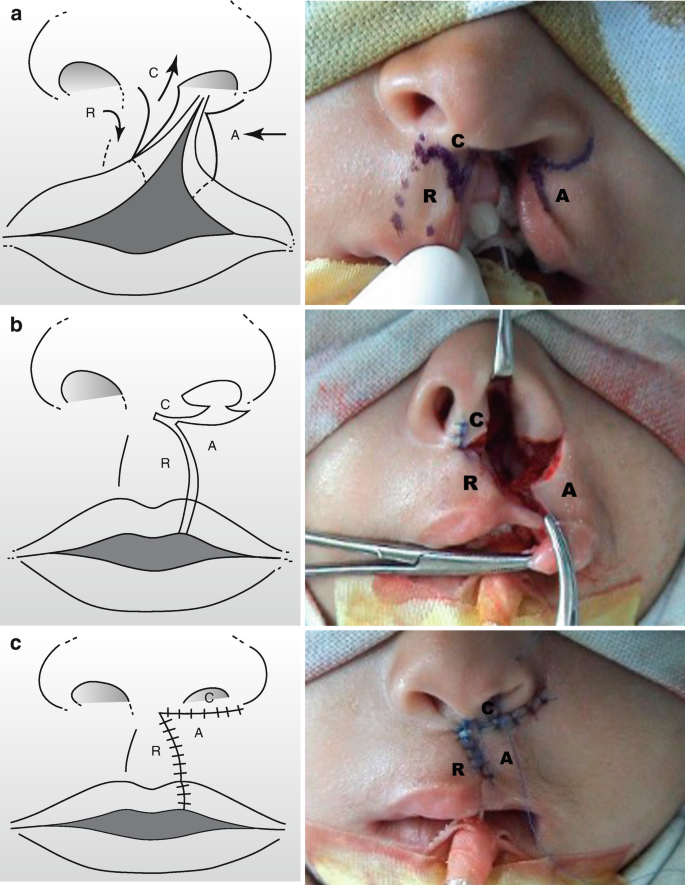 Cleft Lip and Palate | SpringerLink