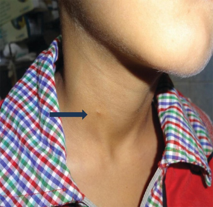 Neck Cysts, Sinuses, Lymphadenopathy, and Torticollis | SpringerLink