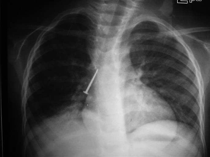 Airway and Esophageal Foreign Bodies, Injuries, and Perforations ...