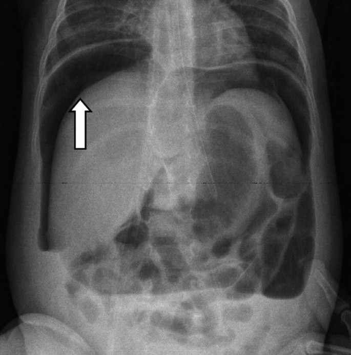 Acute Abdomen in Children | Springer Nature Link