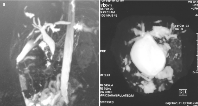 Choledochal Malformations | SpringerLink