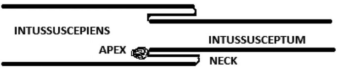 Intussusception | SpringerLink