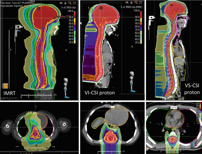 Principles of Radiation Oncology in Children | Springer Nature Link