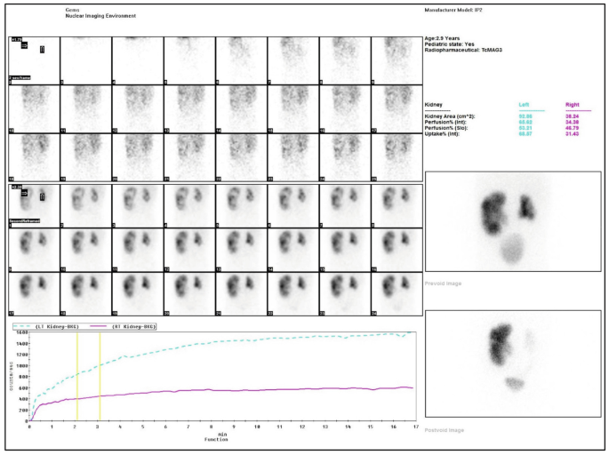 Hydronephrosis and Other Cystic Diseases of Kidney | SpringerLink