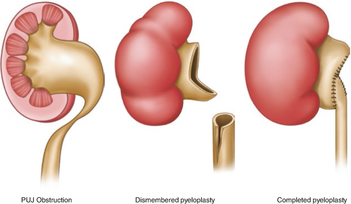 Hydronephrosis and Other Cystic Diseases of Kidney | SpringerLink