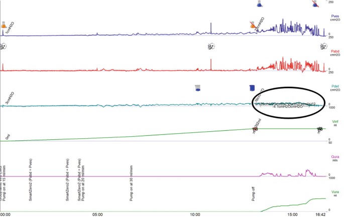 Role of Urodynamics and Interpretation in Children | Springer Nature Link