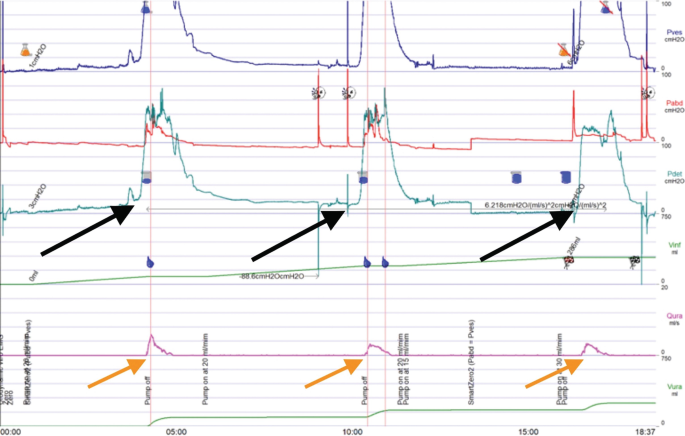 Role of Urodynamics and Interpretation in Children | Springer Nature Link