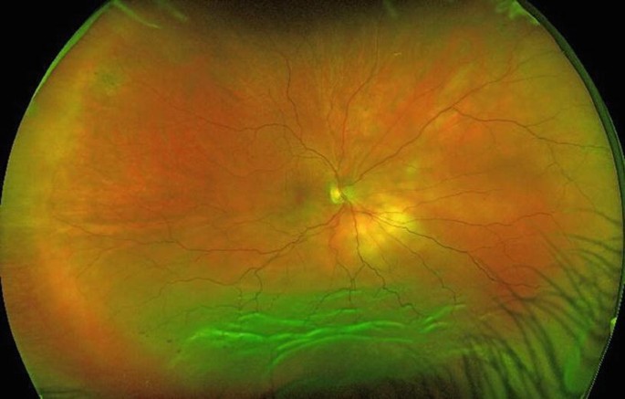 Clinical Review of Sclera and Conjunctiva | Springer Nature Link