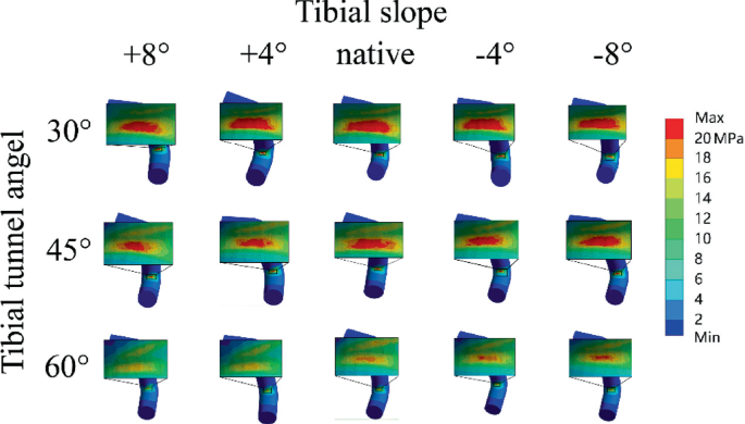 Biomechanical Analysis of the Effect of Tibial Slope and Tibial Tunnel ...