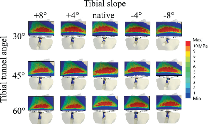 Biomechanical Analysis of the Effect of Tibial Slope and Tibial Tunnel ...