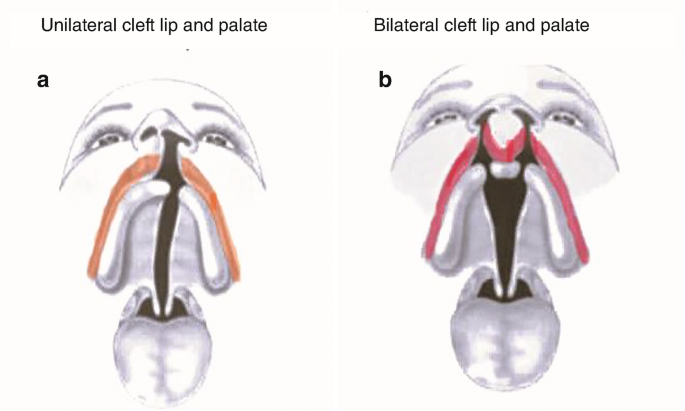 History and Examination of Craniofacial Anomalies | SpringerLink