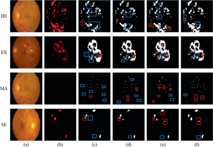 Integrated Grading and Segmentation for Diabetic Retinopathy: A ...