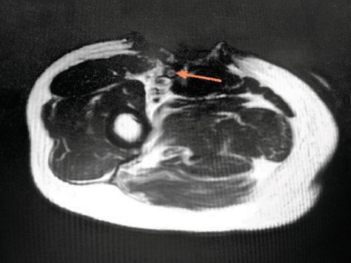 Two Cases of Difficult-to-Treat Cancerous Wounds in the Groin Area ...