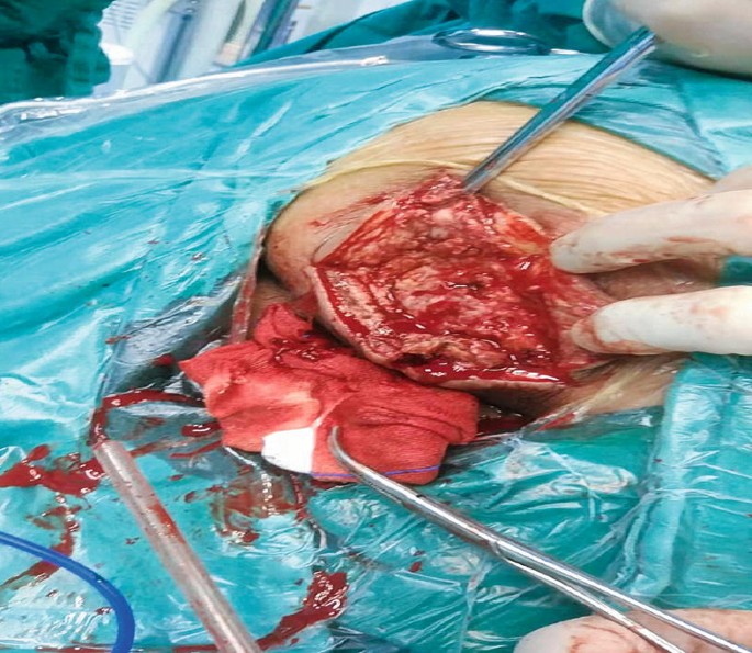 Soft Tissue Infection Wound: One Case | SpringerLink