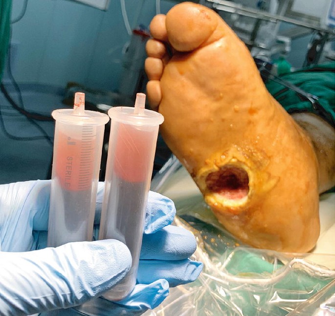 A Case of Repairing Diabetic Foot Ulcer with Injectable Platelet-Rich ...