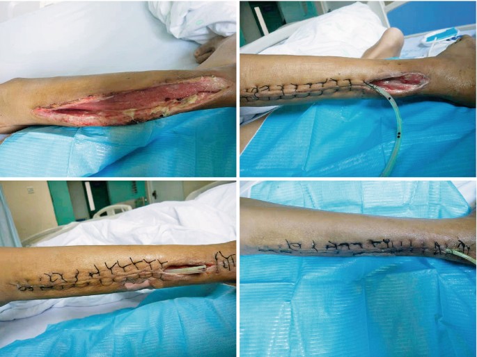 Two Cases of Lower Extremity Diabetic Necrotizing Fasciitis Wounds ...