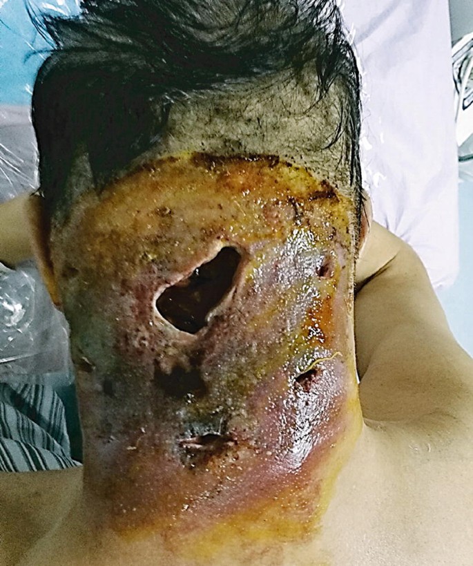 Case of Necrotizing Fasciitis of the Neck in a Patient with Diabetes ...