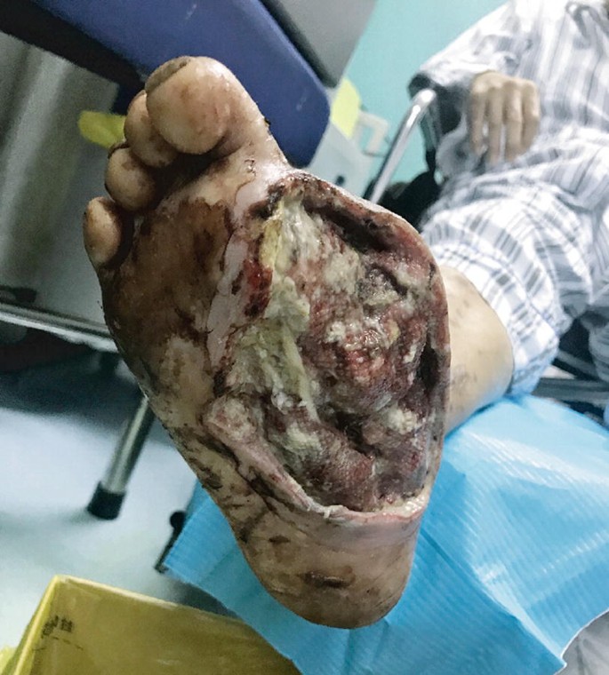 A Case of Diabetic Foot Complicated with Osteomyelitis and Refractory ...